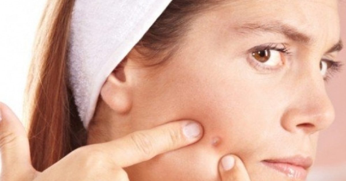 Dermatologista explica como espinha pode causar inúmeras infecções