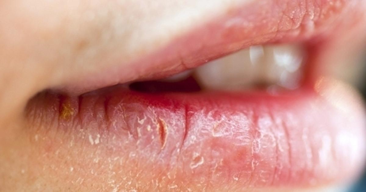 Lábios ressecados podem causar sérias doenças