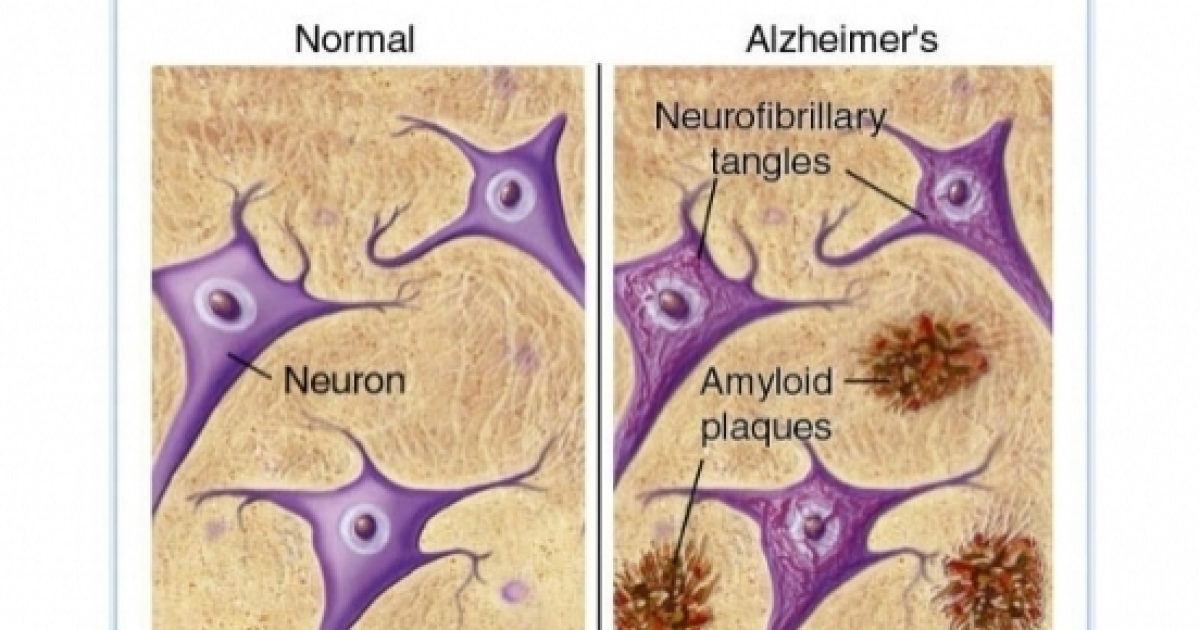 Morbo di Alzheimer: scoperto l'enzima che rende innocue le placche amiloidi