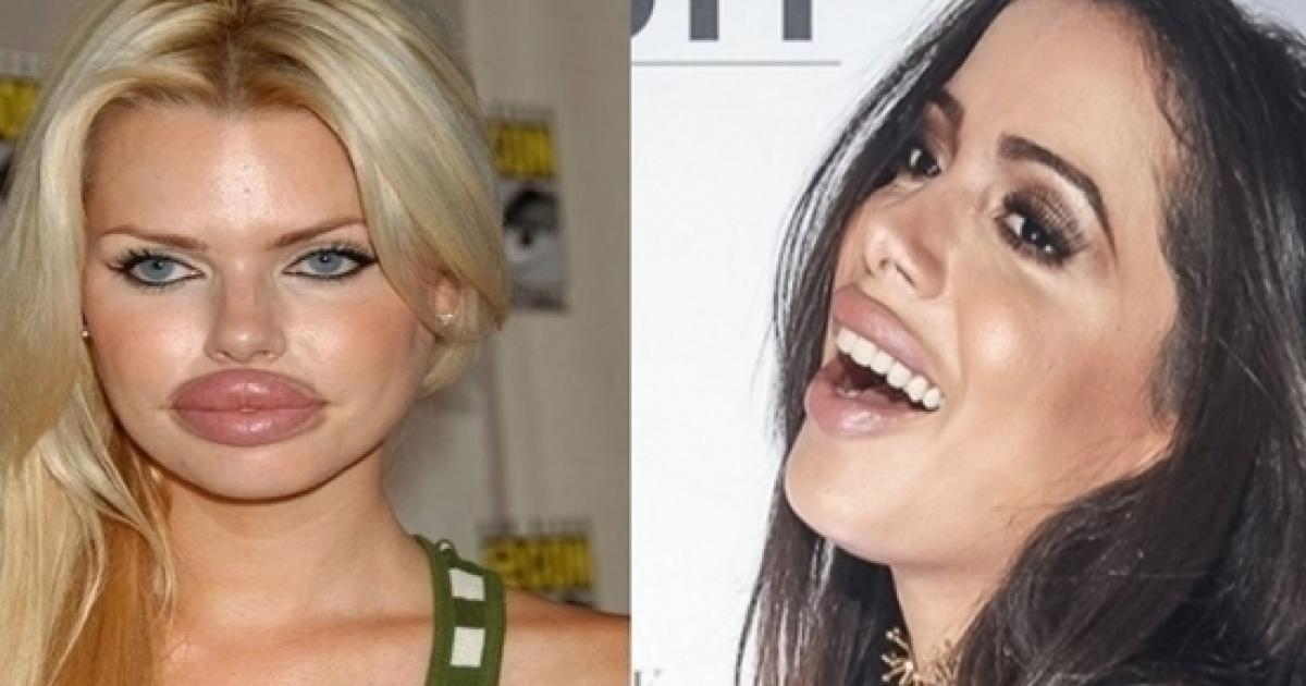 Mulheres que não são mais as mesmas depois do botox