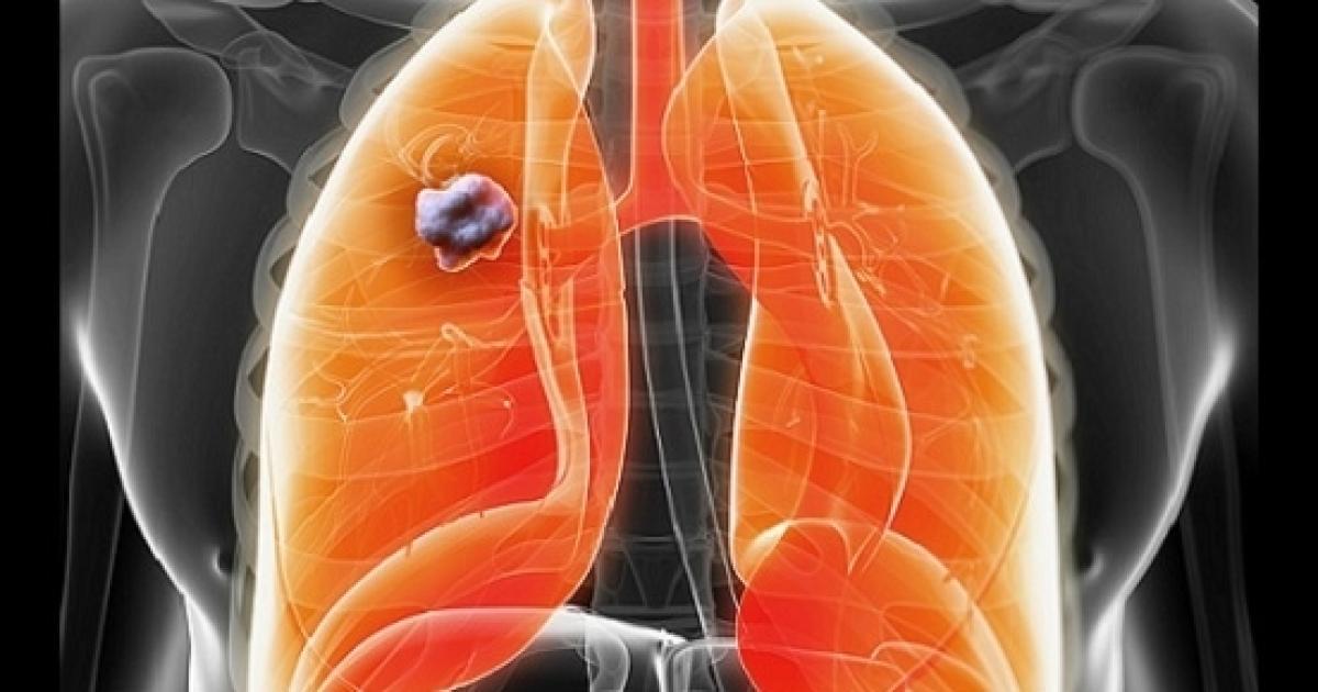 Tumore al polmone, punto a favore della target terapia verso la ...