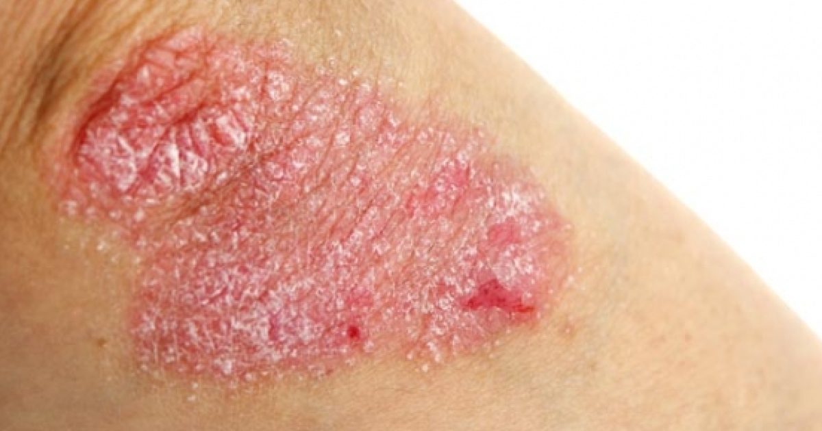 Psoriasi, ideato farmaco biotech ed economico: cura 8 casi su 10