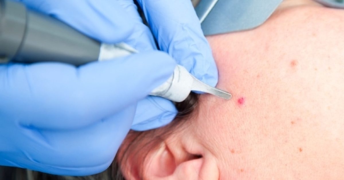 Tumori della pelle o nei benigni e maligni? Riconoscerli e difendersi ...