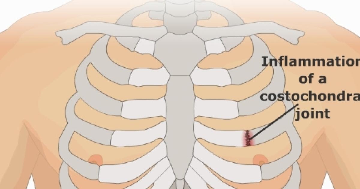 Costochondritis: It's Not a Heart Attack