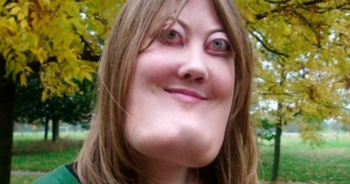 Mulher sofre de rara doença que está deformando seu rosto