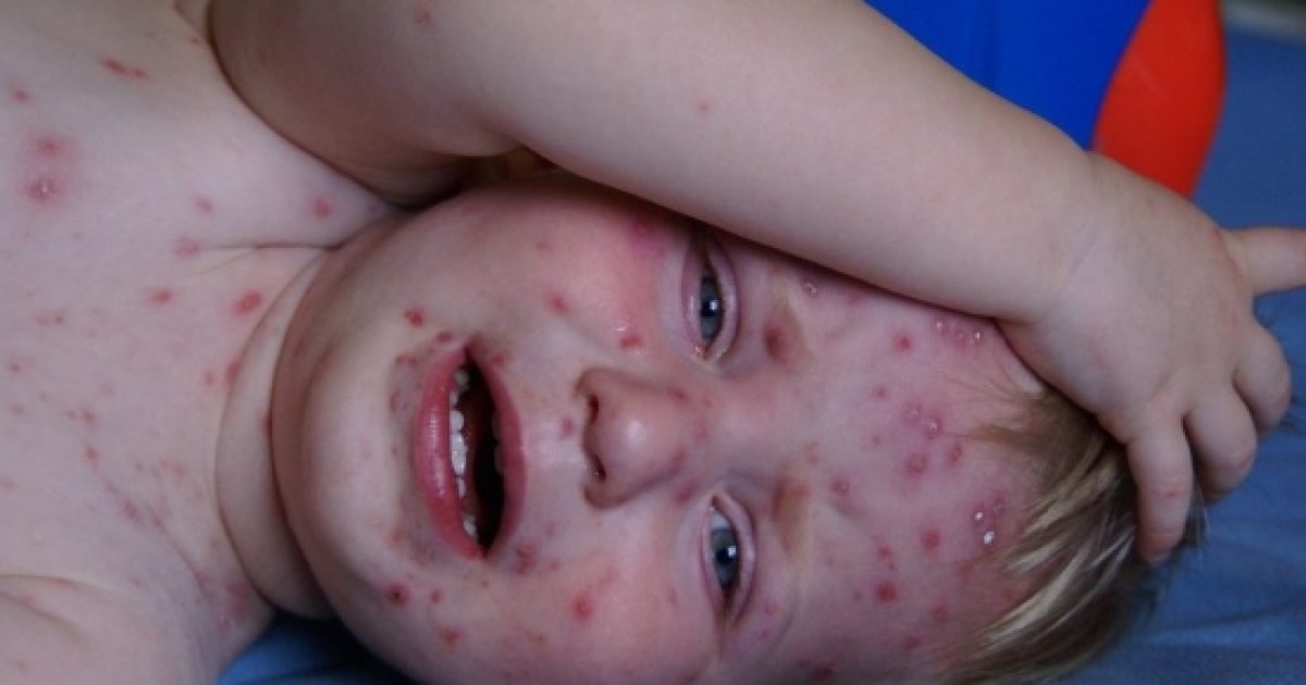 Chickenpox cases dropping thanks to vaccine