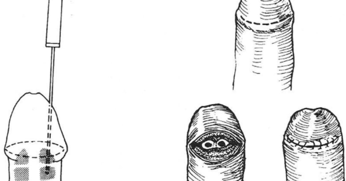 Ecco cosa comporta il priapismo, malattia dell'erezione duratura e ...