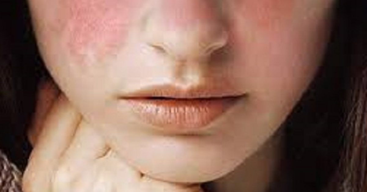 Lupus: qué es y cómo vivir si lo tienes