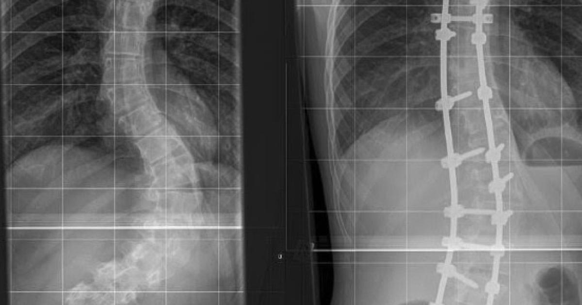 Parents Urged to Watch Their Adolescents for Scoliosis