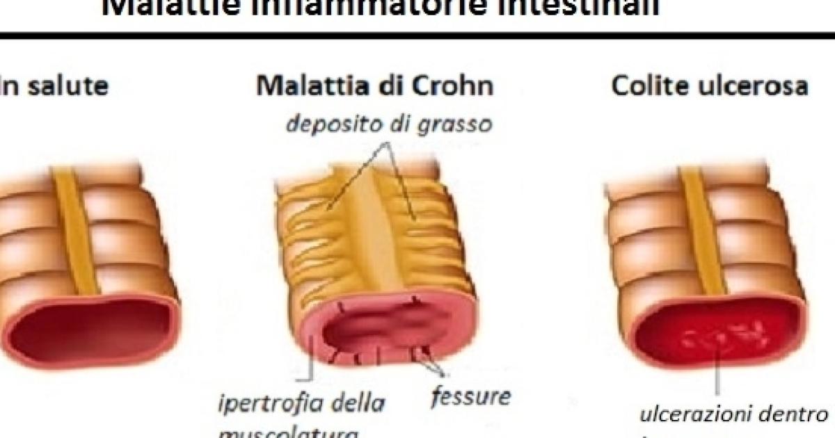 Indagine sul rapporto tra infiammazioni intestinali, farmaci anti-TNF e ...