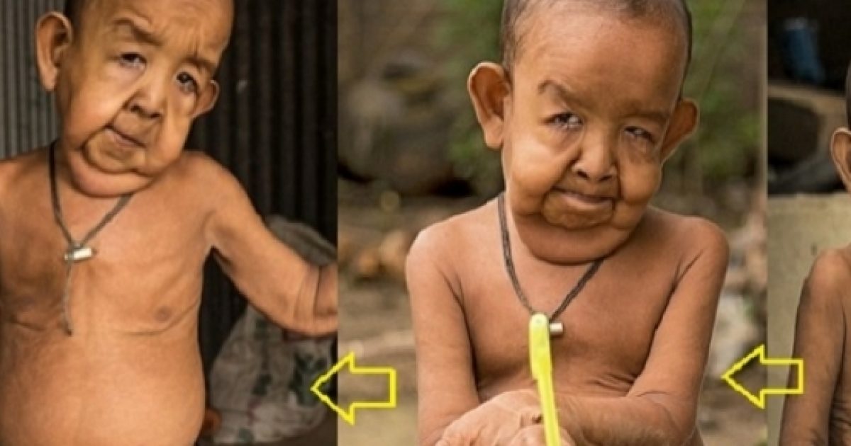 O curioso caso de Benjamim Button da vida real, veja o que acontece com ...