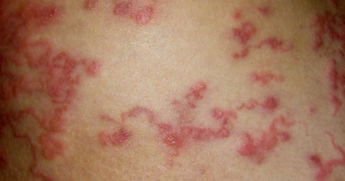 Rientro dai Caraibi col verme: sotto la pelle ha la 'Larva migrans cutanea'