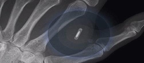 Employees of Wisconsin firm volunteer to have microchip implant