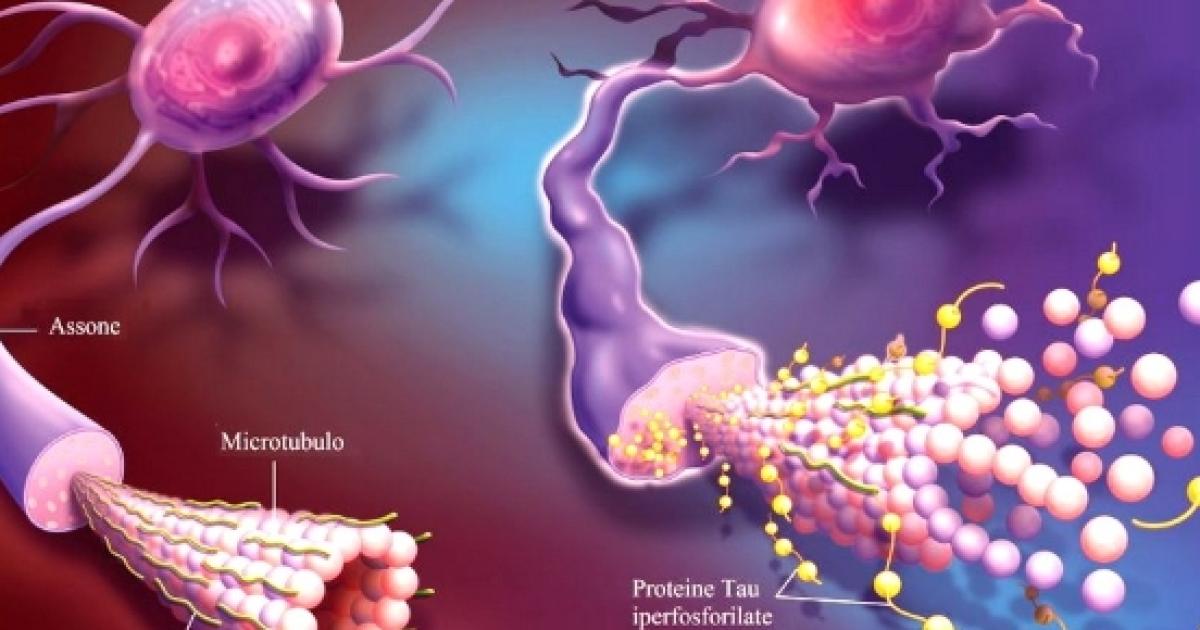 Alzheimer: eccezionale scoperta, la proteina Tau rivela i suoi segreti