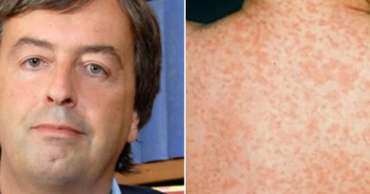 Morbillo ed epidemia: attenzione alla panencefalite