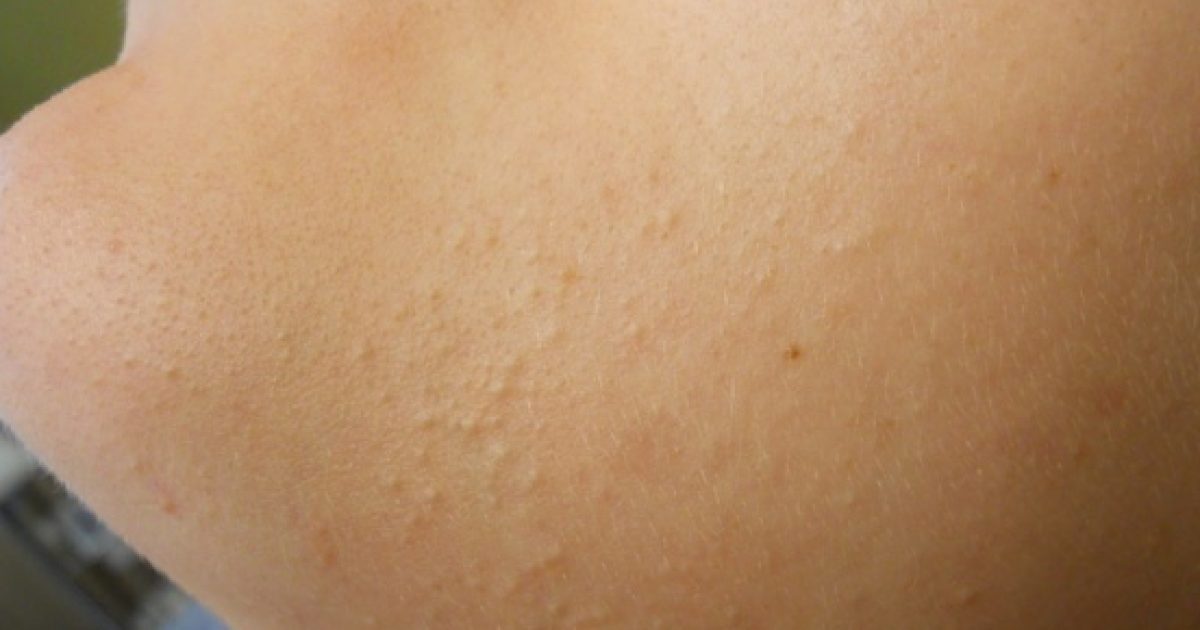 Brufolo si trasforma in un tumore di 5 chili