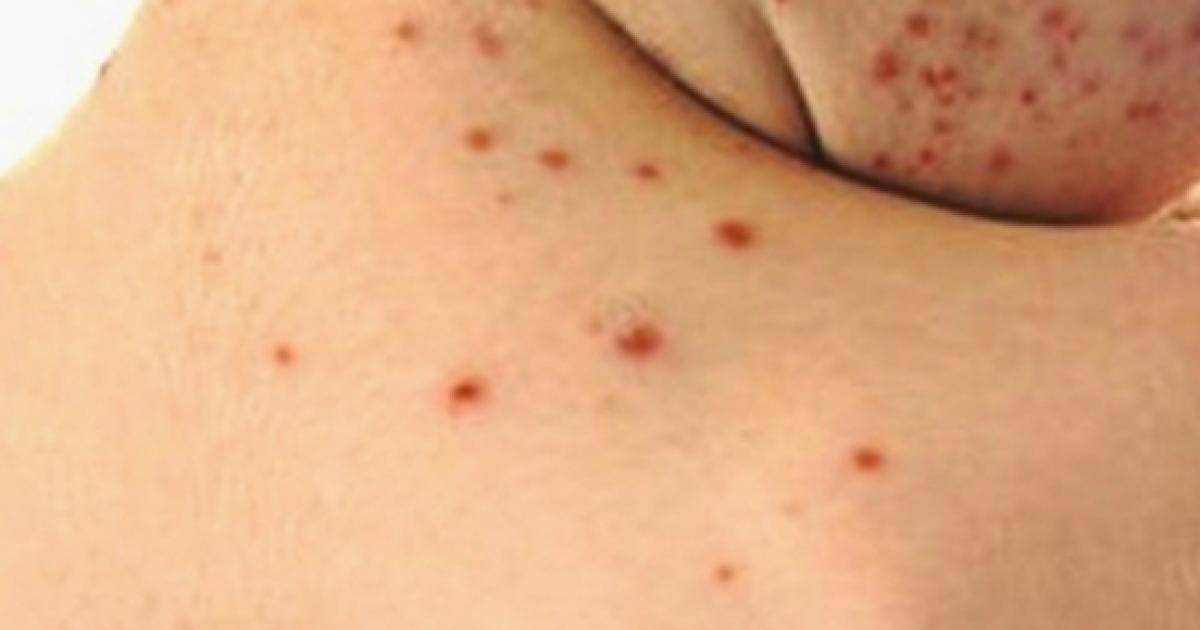 Morbillo di nuovo tra le malattie più contagiose: sempre più casi in Europa