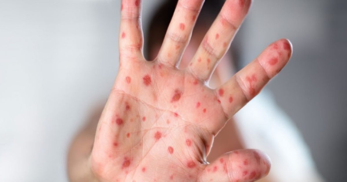 Allerta morbillo, aumento dei casi del 400%: sintomi, contagio e cura