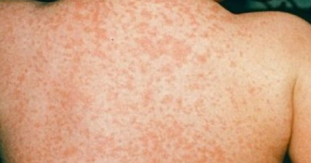 Morbillo in Italia, l'appello della Lorenzin: 'Vaccinatevi'