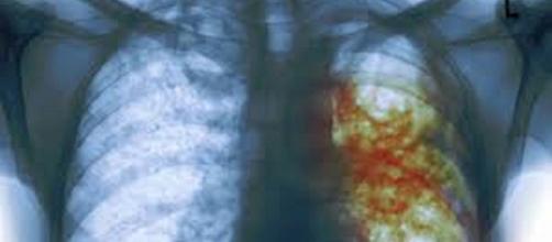 Tuberculosis: una enfermedad de salud pública