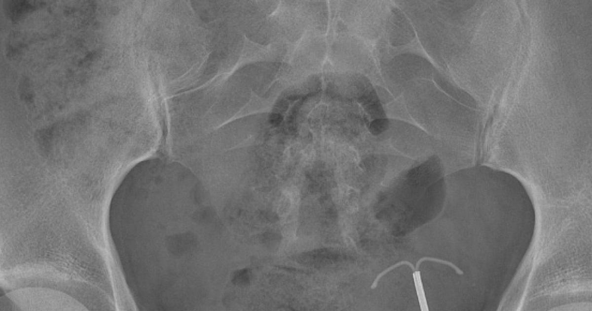 Surgical sponge left inside a woman's abdomen for 6 years