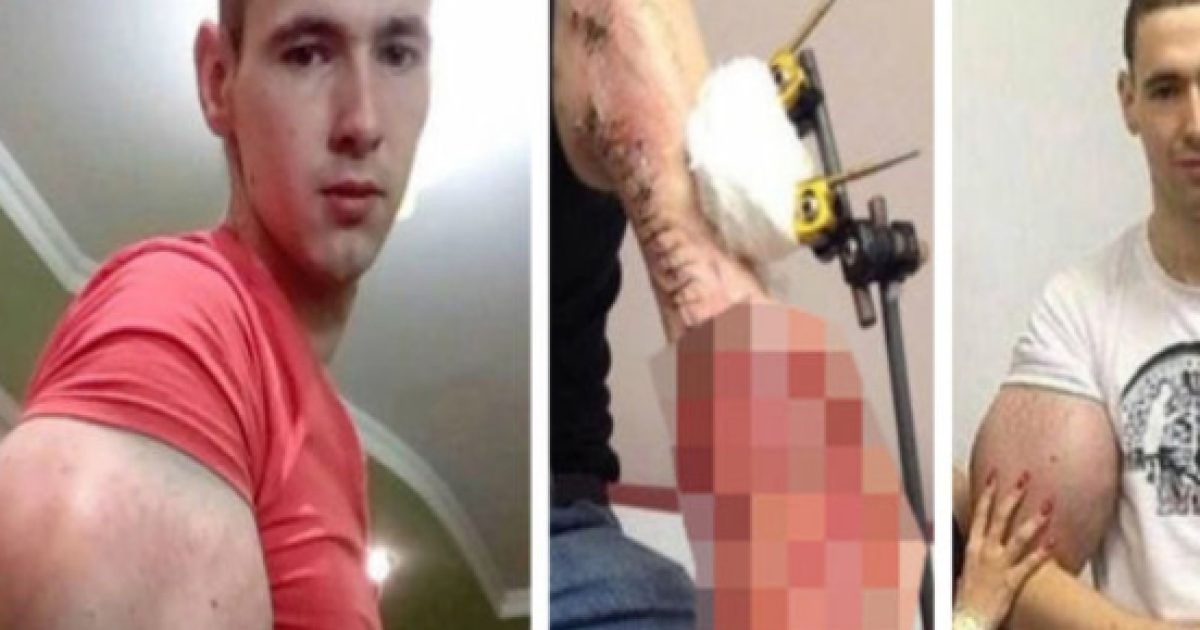 Lembra do Popeye russo? Ele pode ter que amputar os braços