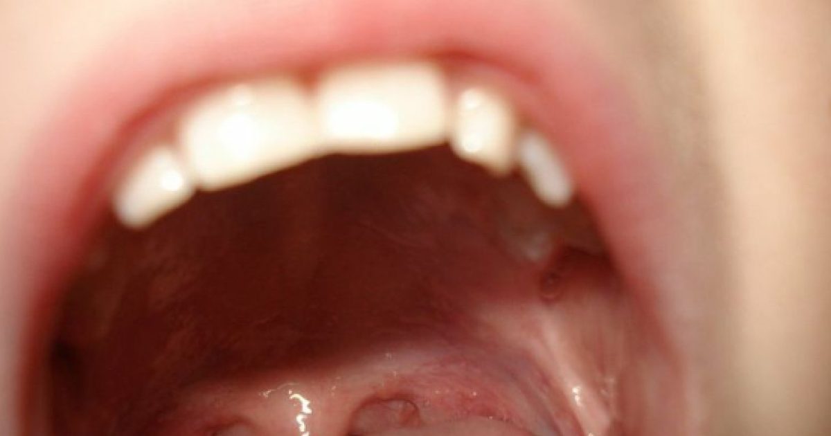 Aftas bucales. Conoce su origen y prevención