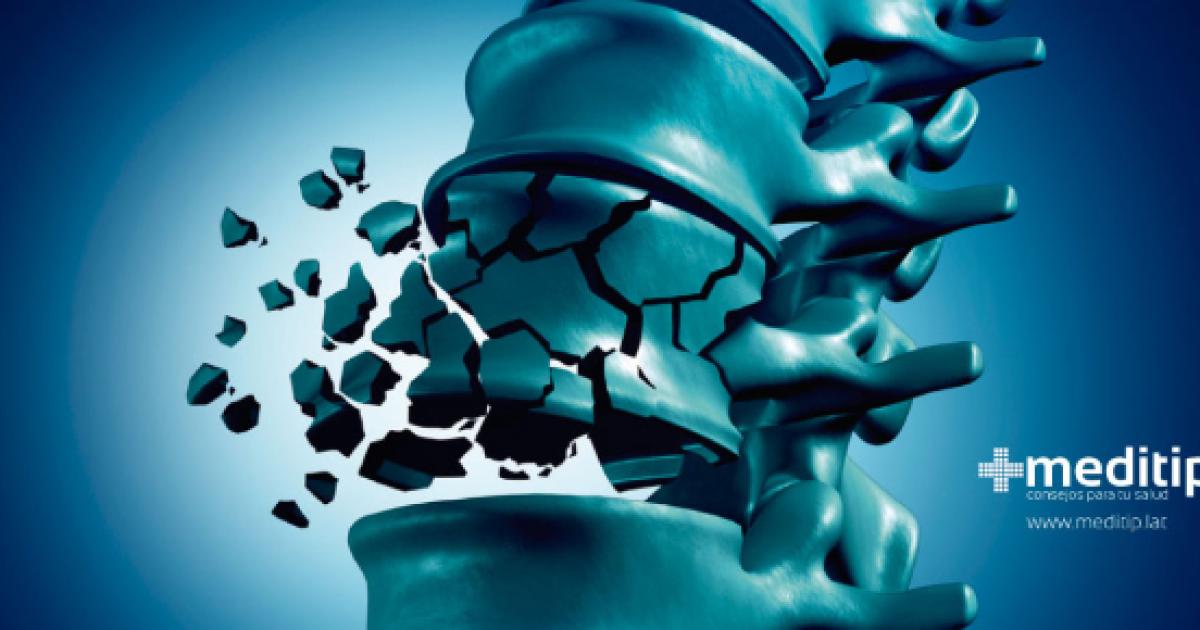 Causa y solución de la pérdida ósea