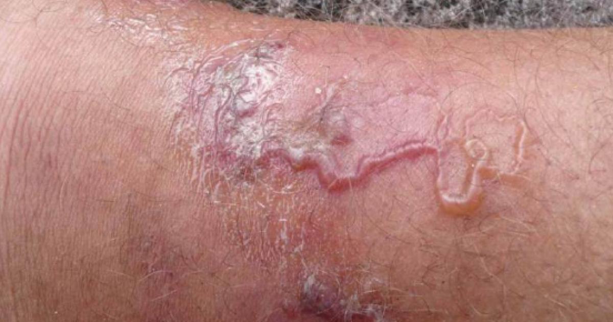 Regreso del Caribe con el gusano: debajo de la piel la 'Larva migrans ...