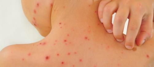 Varicella party: l'annuncio su Facebook che infiamma il web