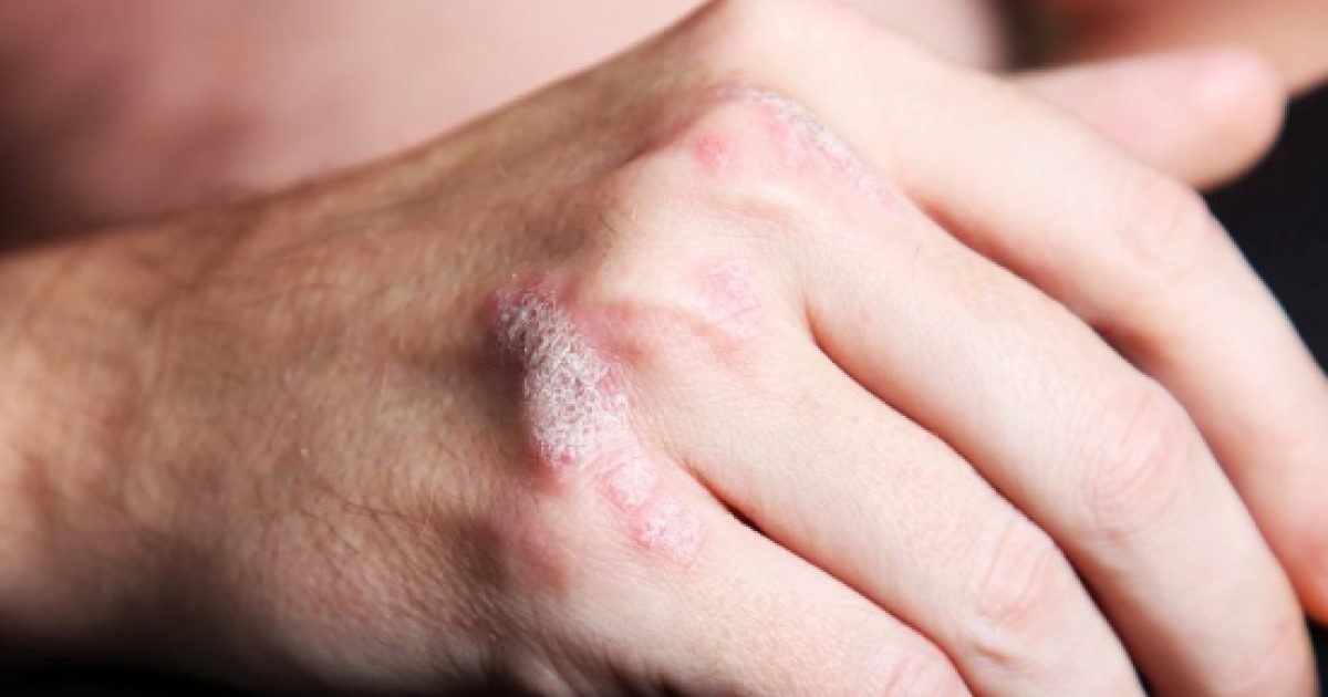 Psoriasis: síntomas y tratamiento