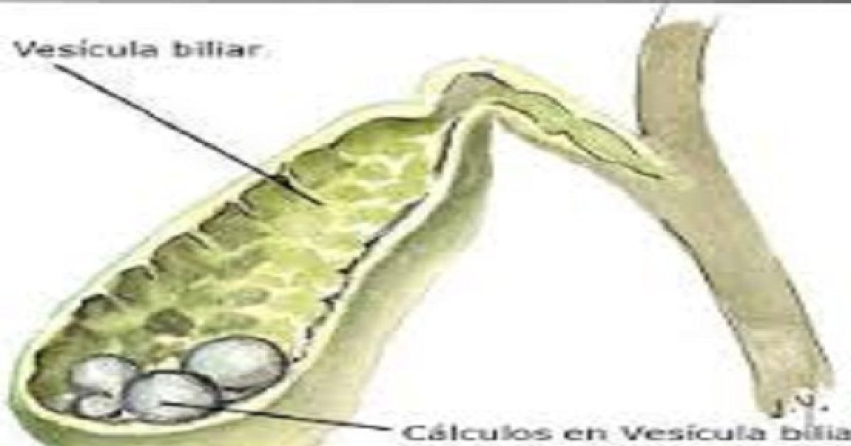 Litiasis vesícular o cálculos biliares: diagnóstico y tratamiento