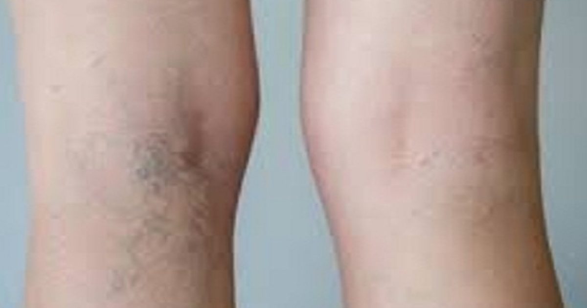 Las varices, una enfermedad hereditaria