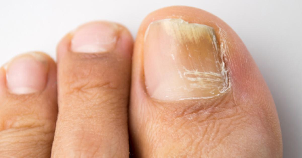 Las micosis de las uñas: Síntomas, contagio y cuidados