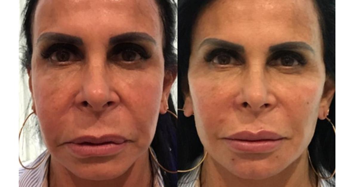 5 famosos antes e depois de realizarem o procedimento de harmonização ...