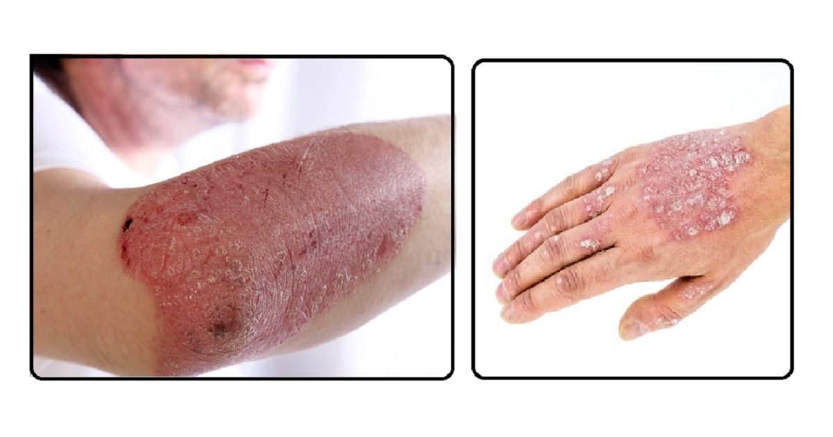 Via libera della CE a Skyrizi, l’anti psoriasi biologico di AbbVie