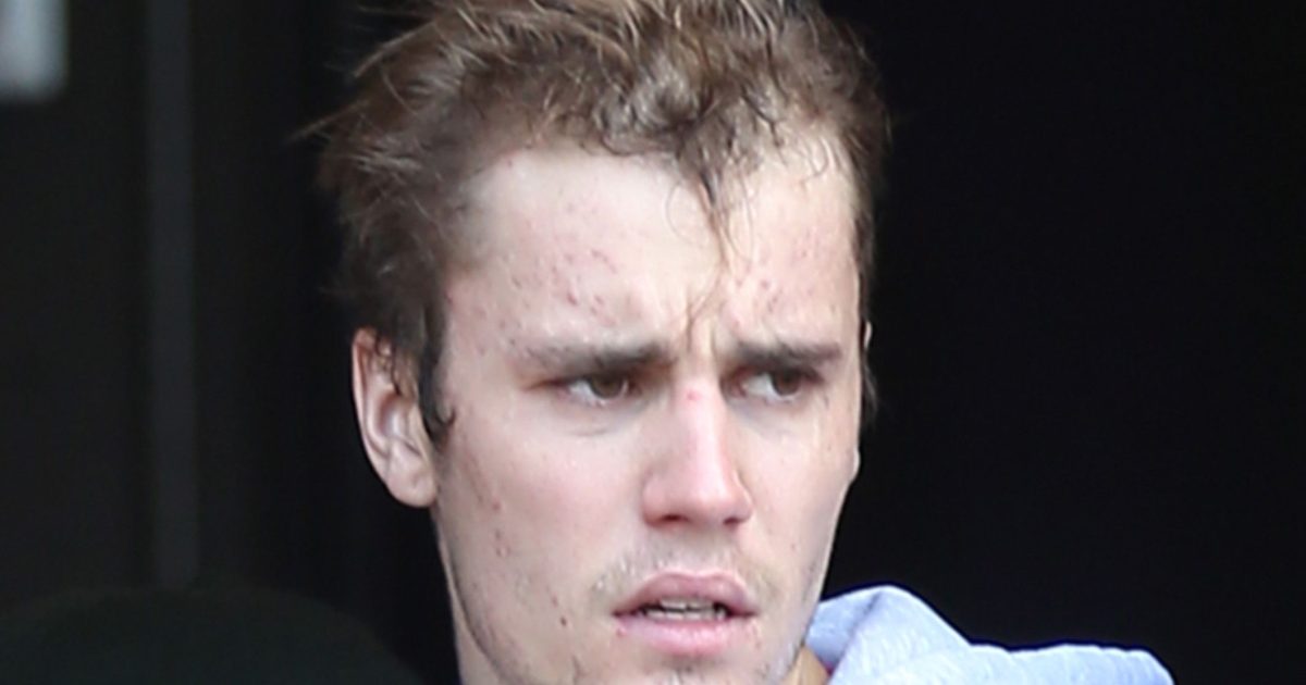 Justin Bieber é diagnosticado com doença de Lyme
