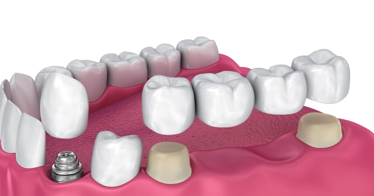Capsule dentali: quali sono i migliori materiali e come scegliere